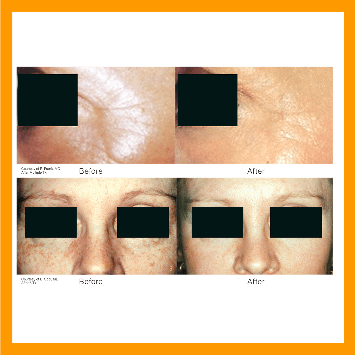 Revlite Laser | Melasma, Dark Underarms, Tattoo Removal,Skin Lightening