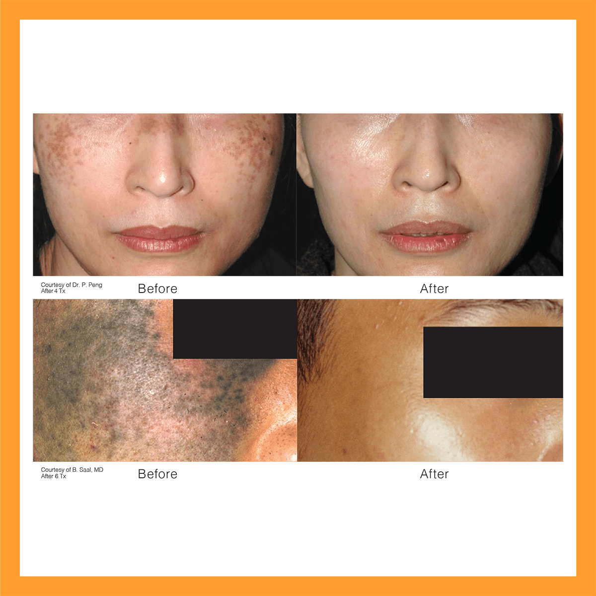Revlite Laser | Melasma, Dark Underarms, Tattoo Removal,Skin Lightening